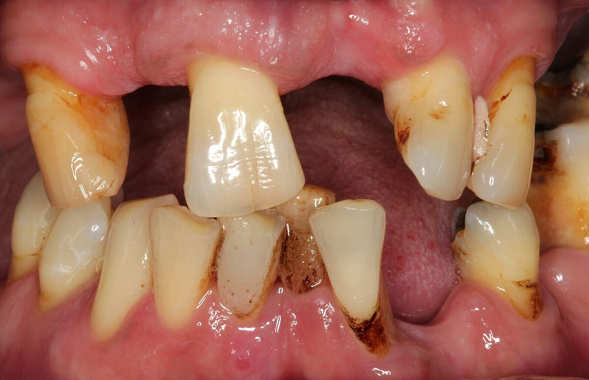 Knochendefekte und Knochenverlust am Kiefer