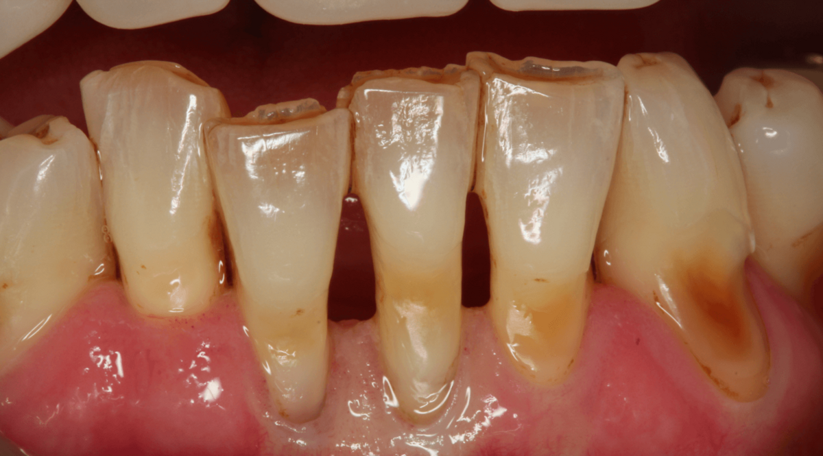 Behandlung von Mundgeruch: Was hilft wirklich?