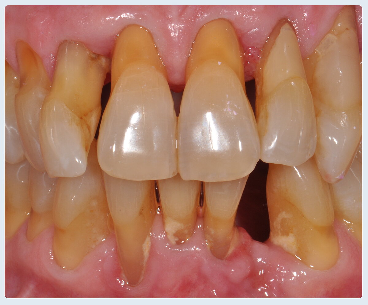 Zahnverlust: Die häufigsten Ursachen für Zahnverlust