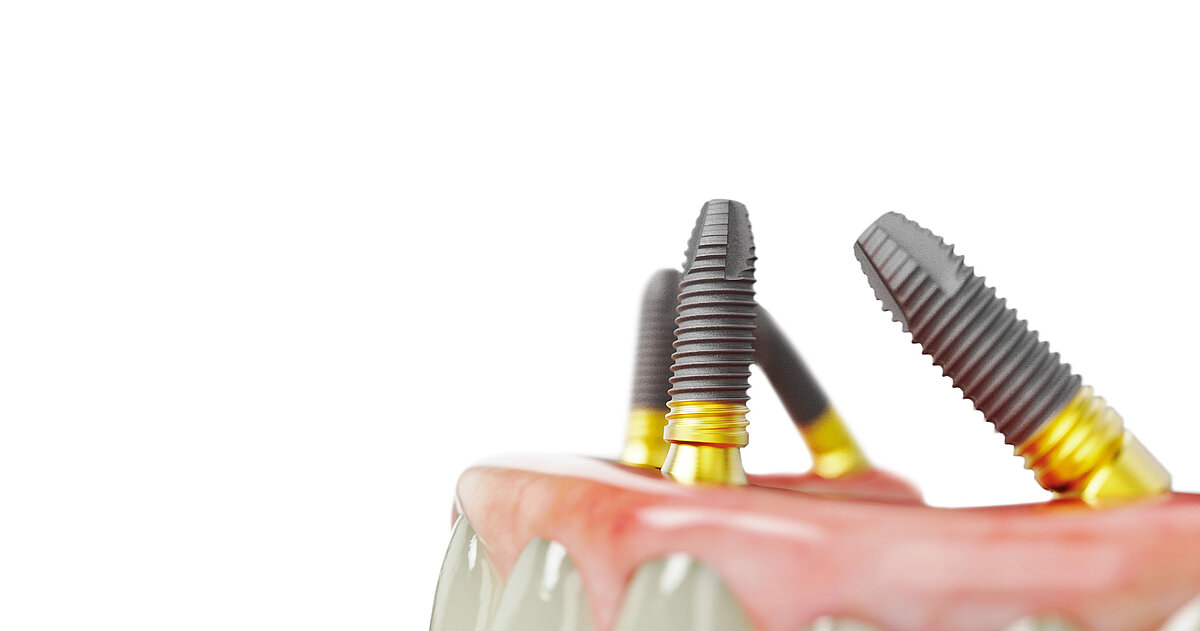 Nachsorge und Pflege von Zahnimplantaten